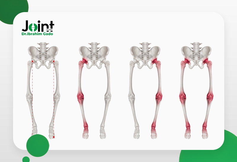 Bowlegs or Genu Varum ( External curvature of the legs ) - Joint Clinic