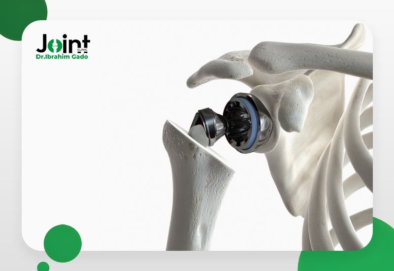 Hemi-Shoulder - Joint Clinic